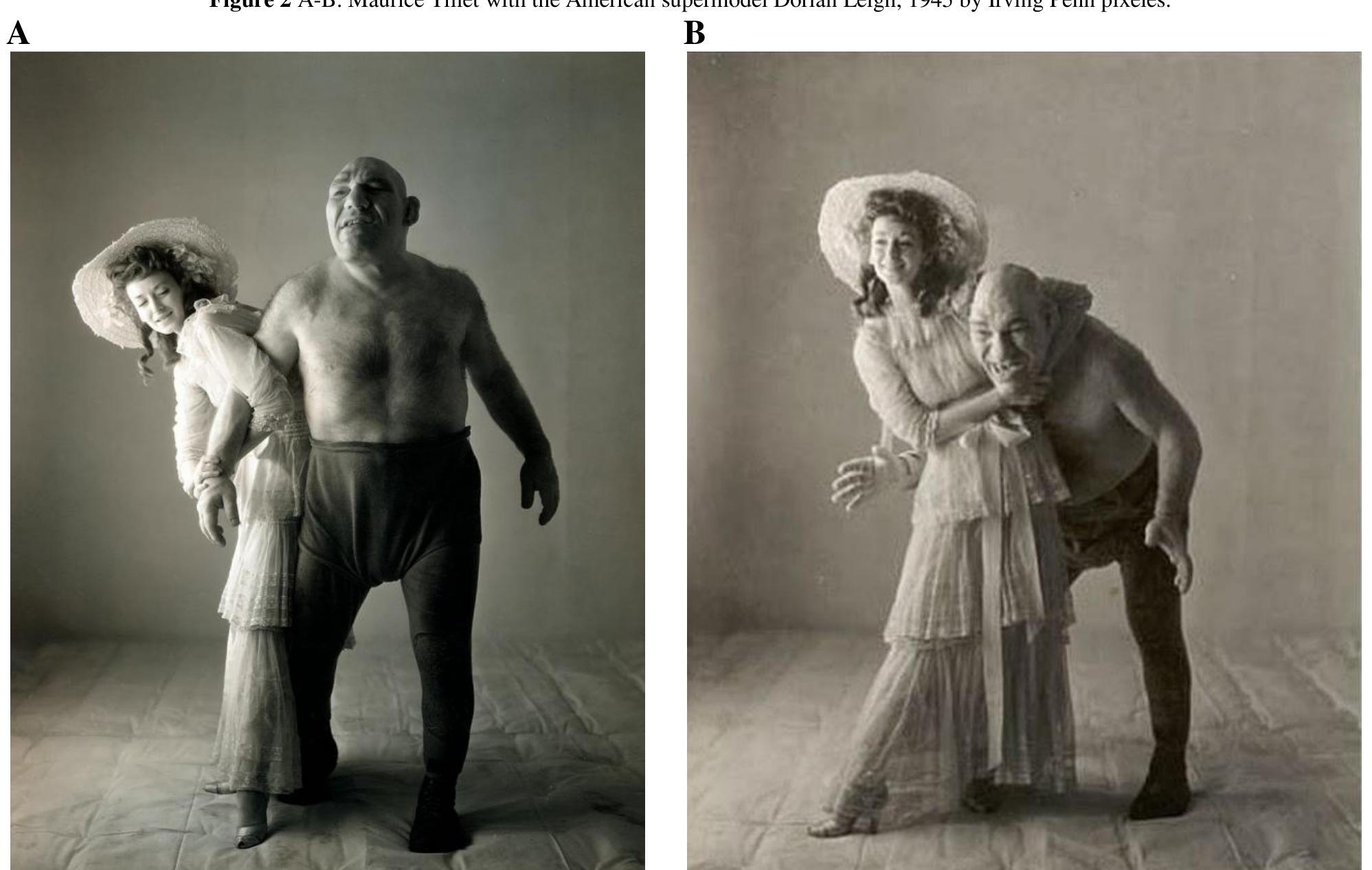 Figure 2 - The man with acromegaly who inspired the Shrek
