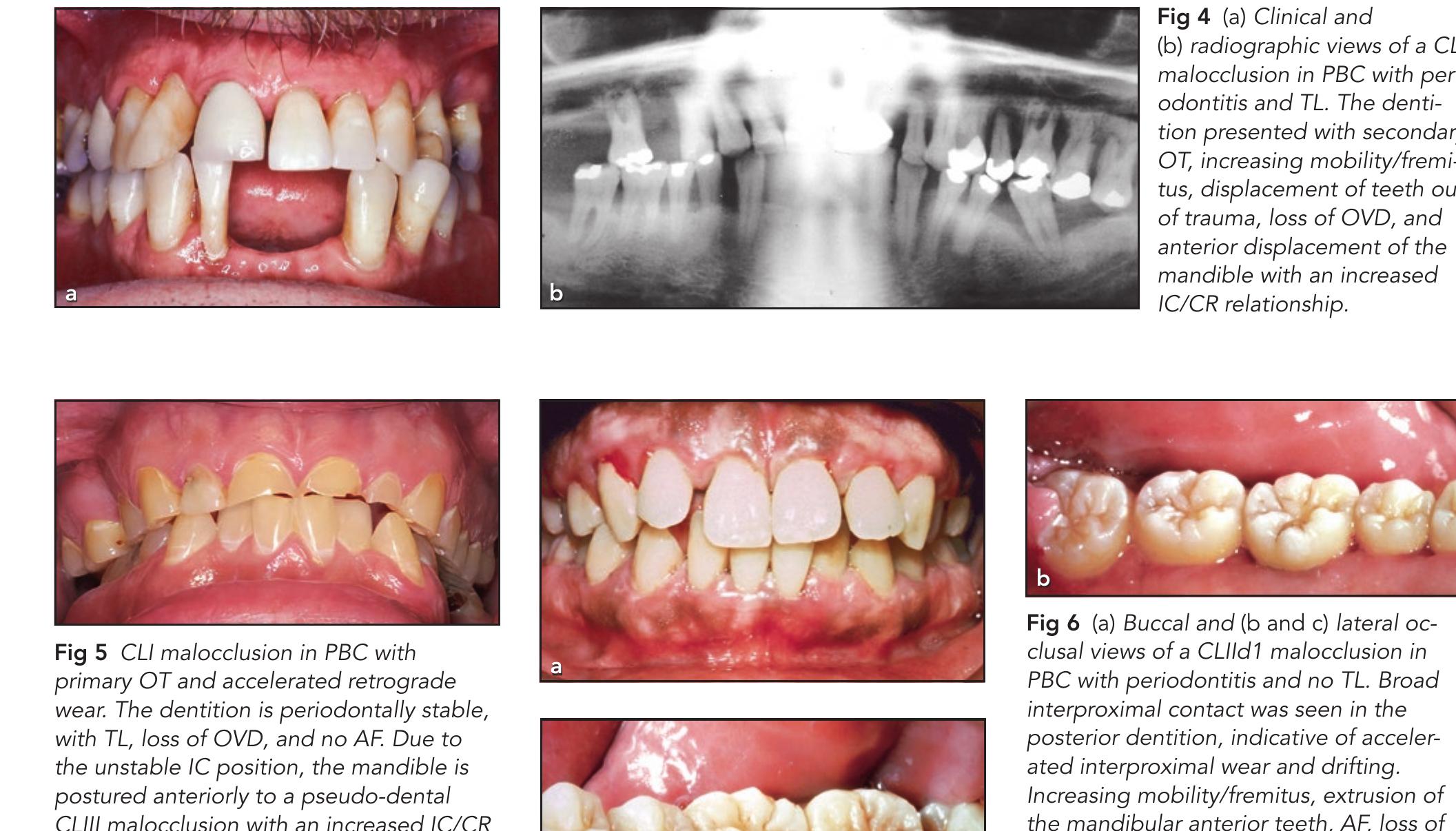 Figure 5 - Posterior Bite Collapse and Diagnostic Grading