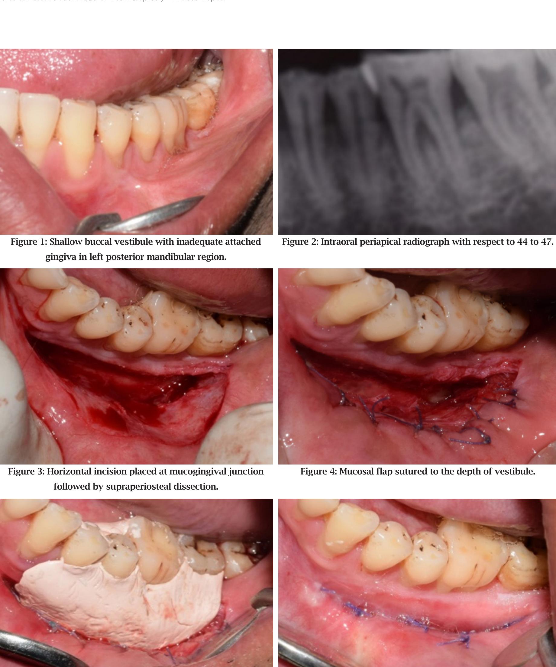 Figure 4 - Clark’s Technique of Vestibuloplasty - A Case
