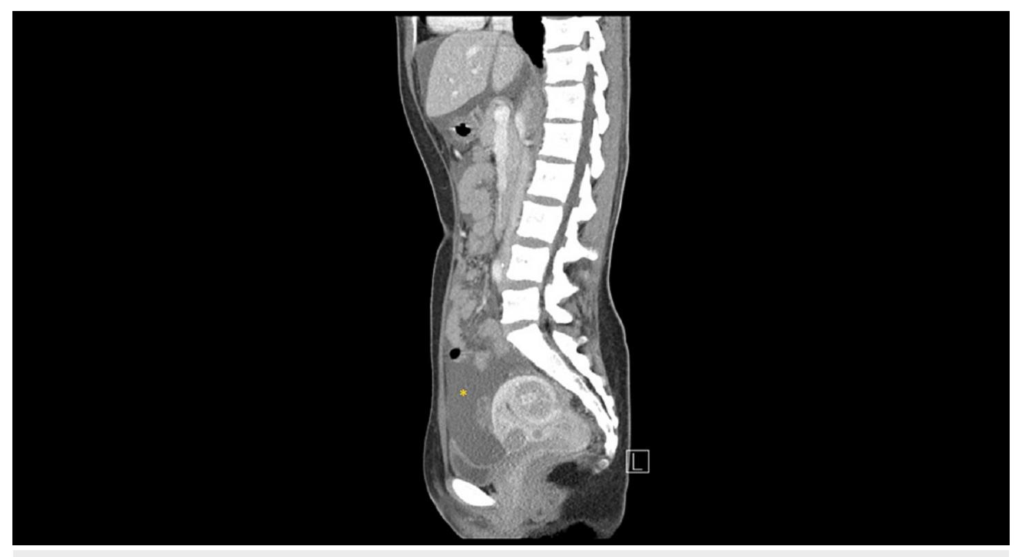 Abdominal ct scan —- sagittal view showing massive ascites