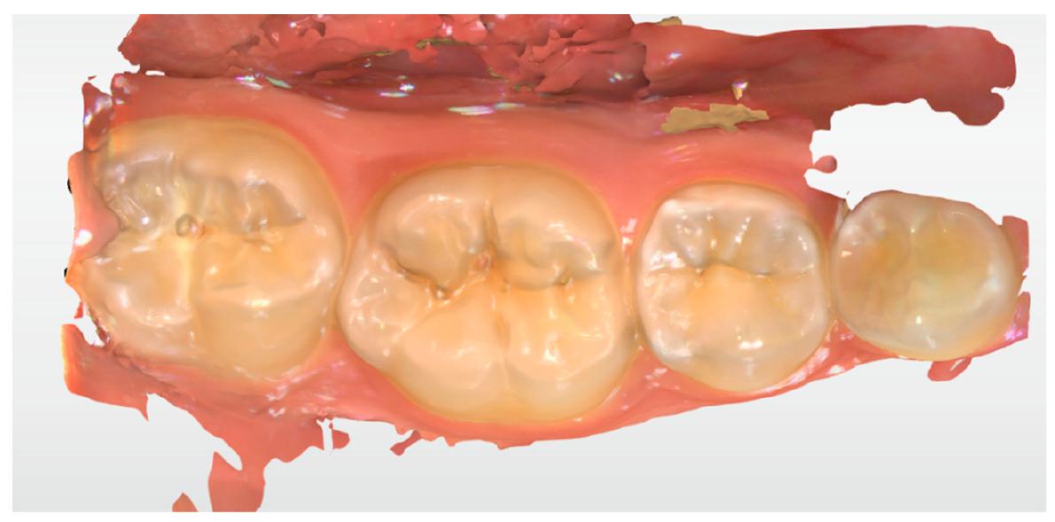 A scan of the antagonist jaw. figure 4. a scan of tooth #16