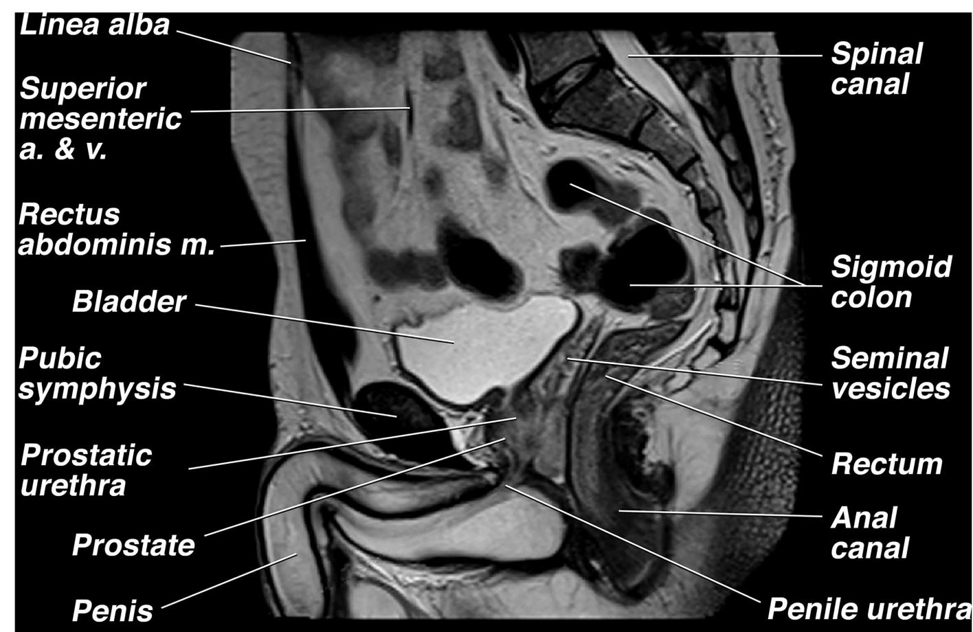 Mri (sagittal) of male lower abdomen and pelvis