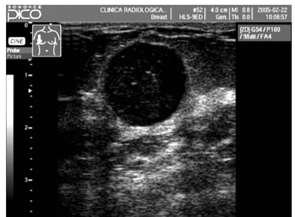 Atypical ultrasound appearance of benign breast nodules fig