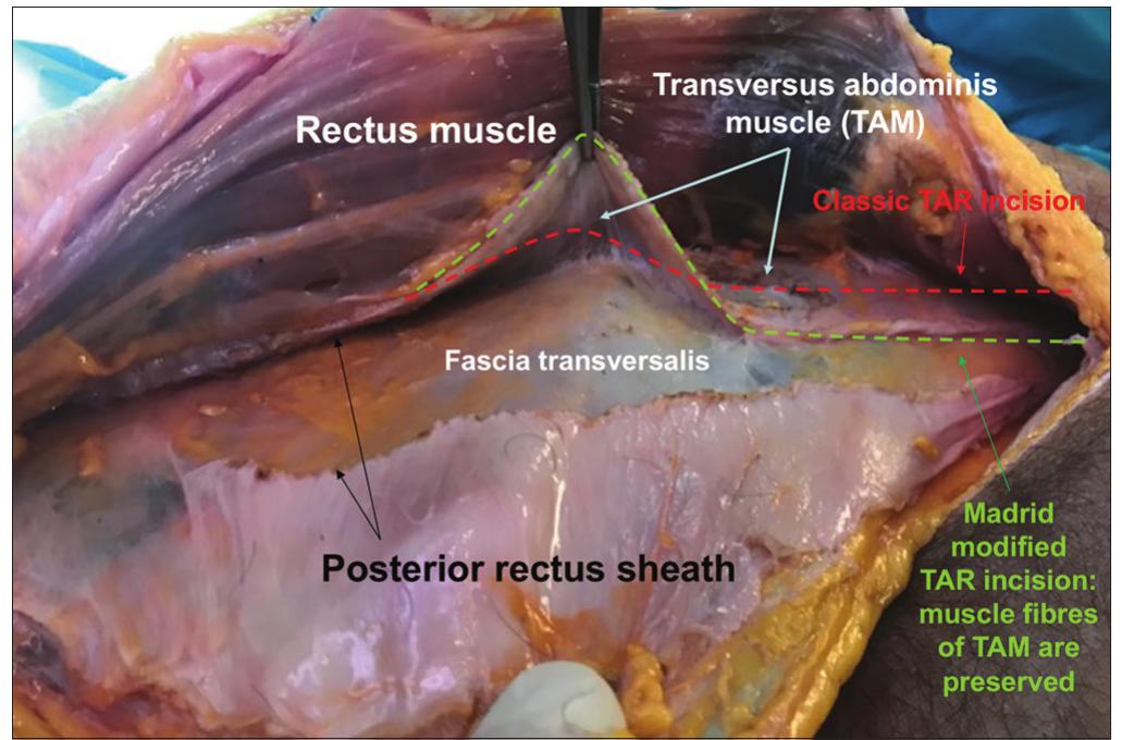 Transversus abdominis muscle release incision completed. the