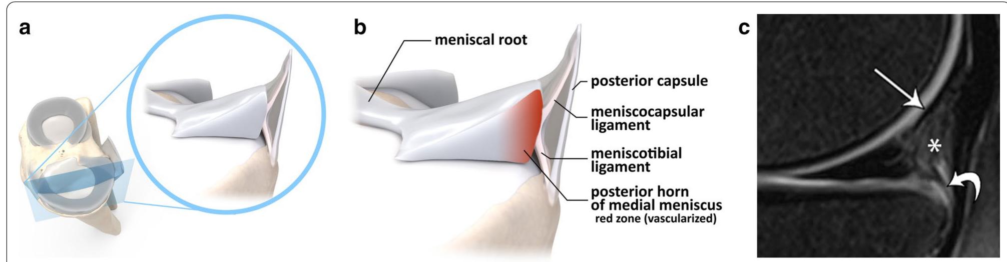 Posterior medial meniscus anatomy, with its corresponding