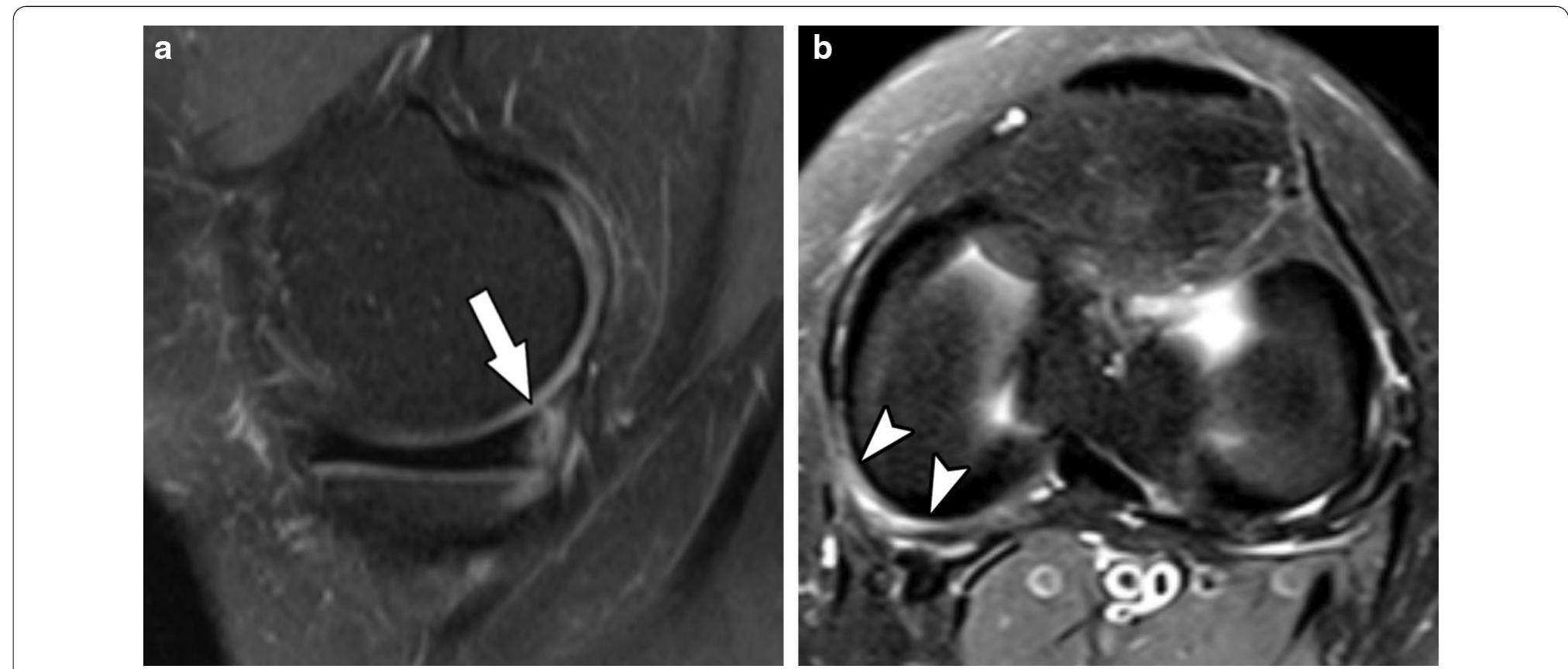 Type 1 meniscal ramp lesion mri case. sagittal (a) and axial