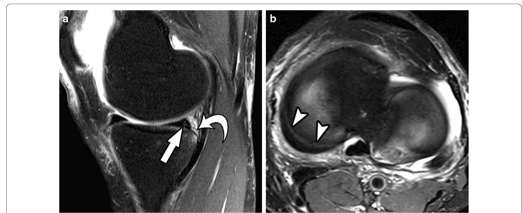 Type 3b meniscal ramp lesion mri case. sagittal (a) and