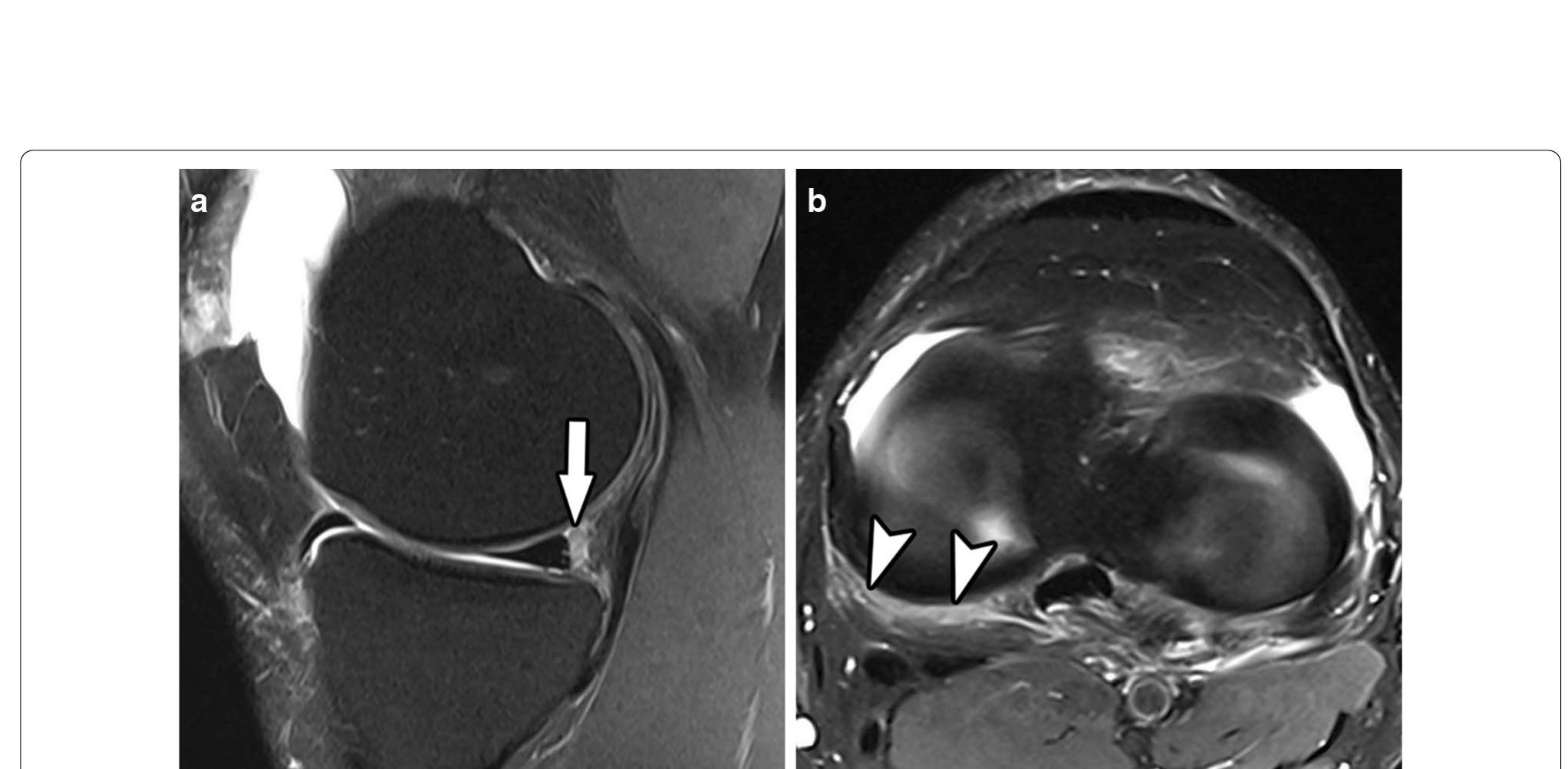 Type 4b meniscal ramp lesion mri case. sagittal (a)