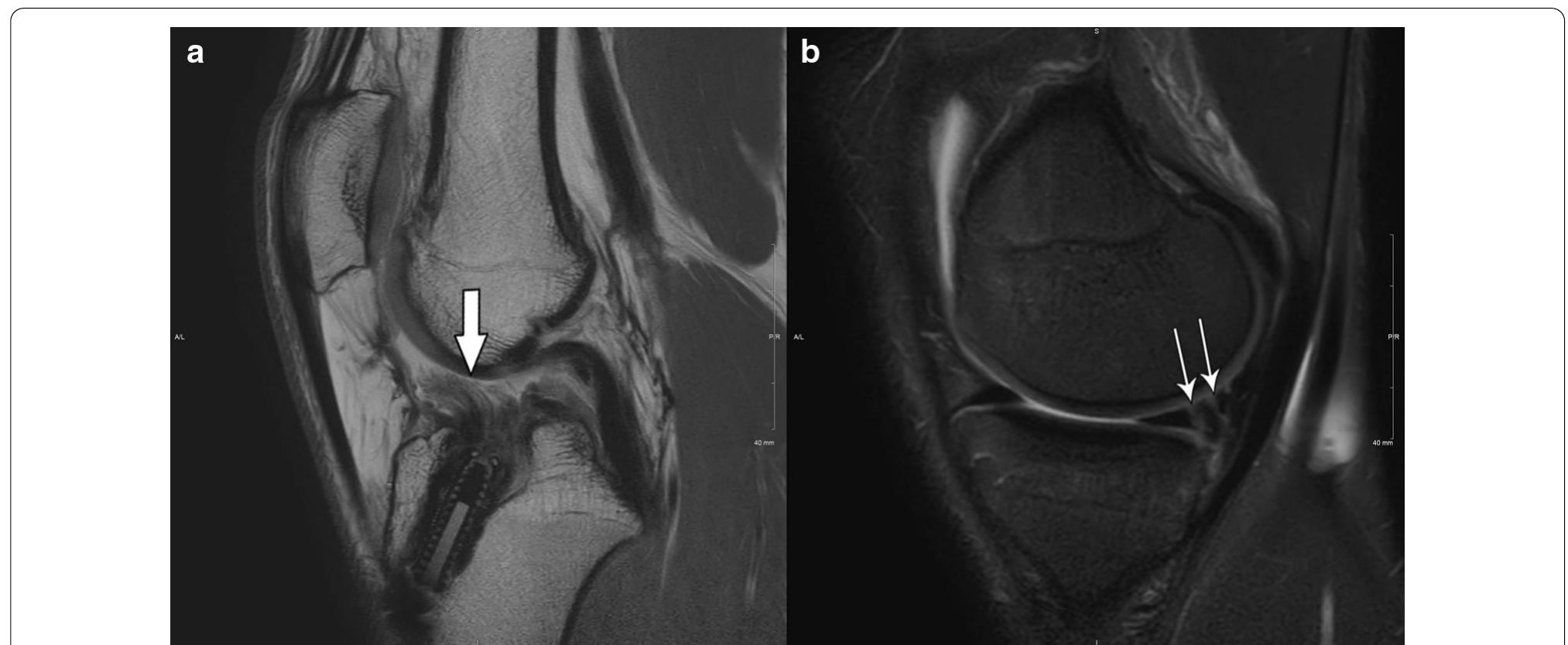 Type 5 meniscal ramp lesion mri case. sagittal pd-weighted
