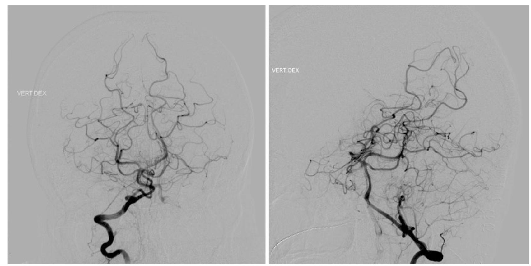 5 post-op vertebral artery angiogram demonstrates complete
