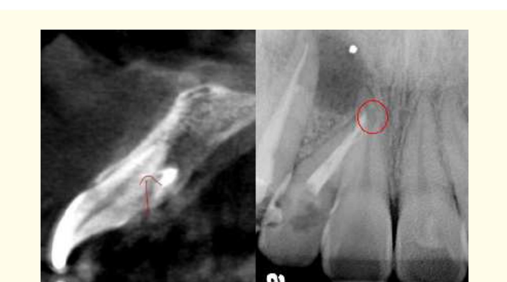 Sagittal plane cbct image and initial radiograph of tooth