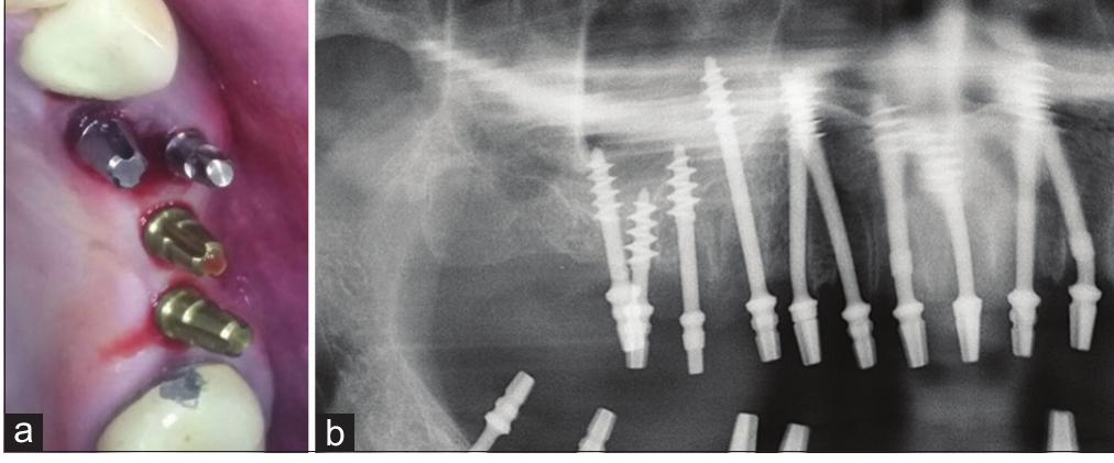 Method 16: (a) two implants are placed into the extraction