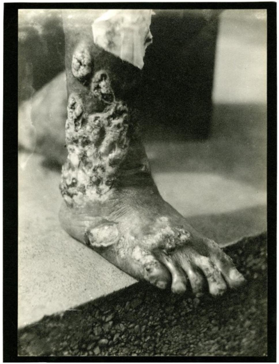6: skin ulceration and bone exposure to right foot. note the