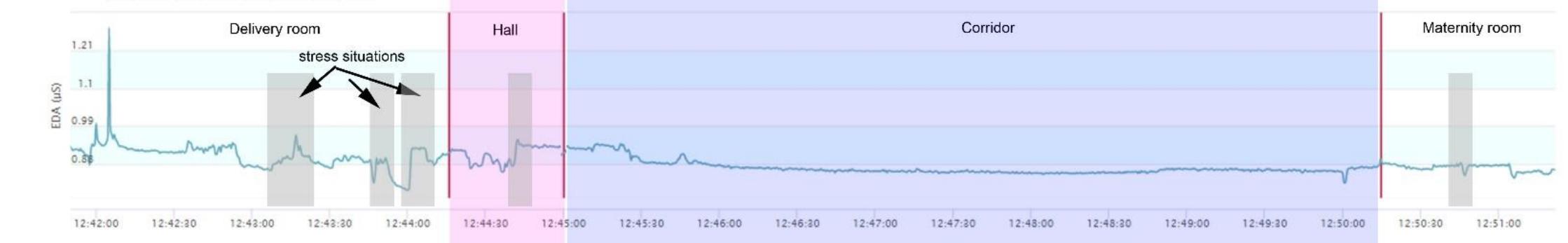 Electrodermal activity (eda) curve of a birthing woman. fig.