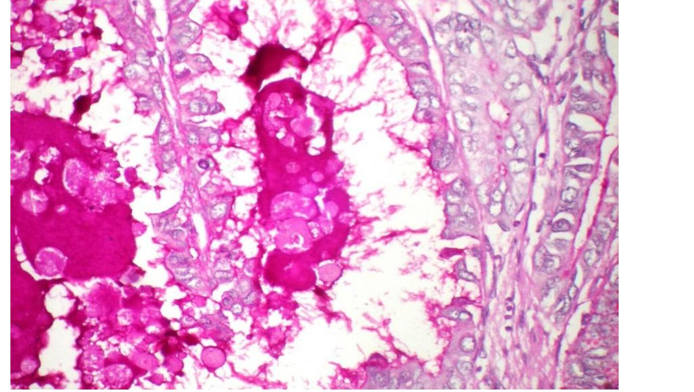 Collecting duct carcinoma showing pas stain positivity