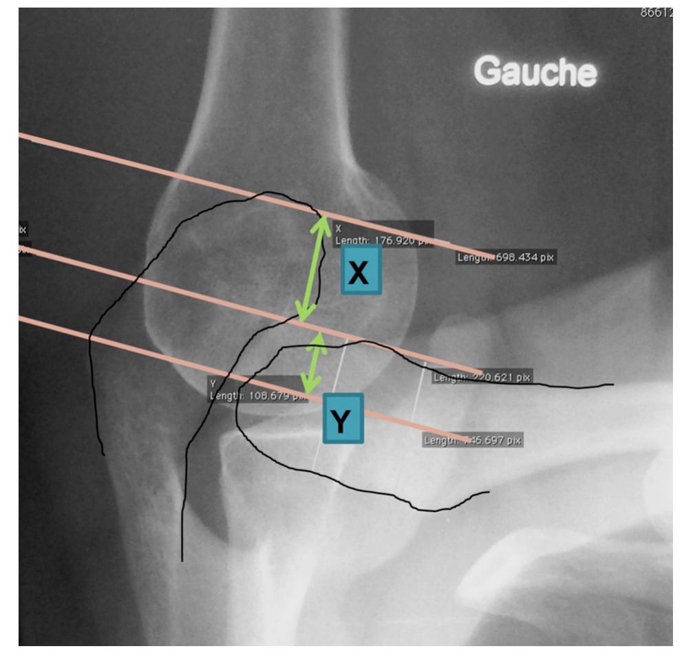 Measurement of x/y ratio on the axillary lateral view to