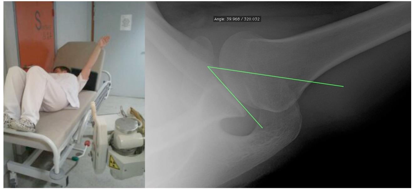 Dynamic lateral radiographs with gaca angles measured in 60°
