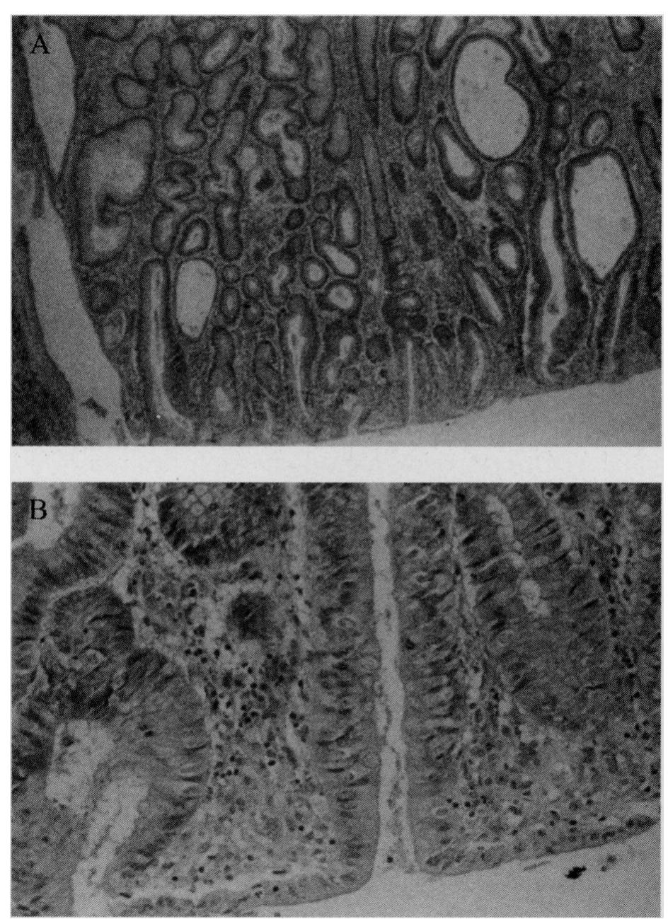 Adenomatous polyp (tubular adenoma) (a) with moderate