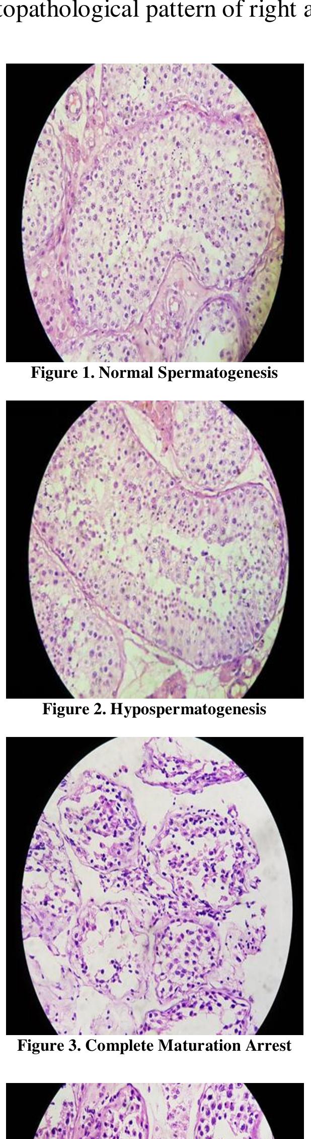 Figure 1 - Histopathological Patterns of Testicular Biopsies