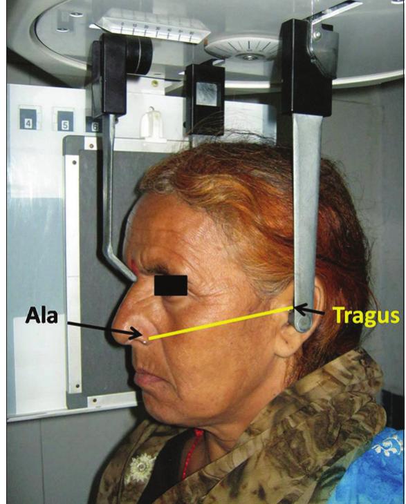 Locating the ala-tragus plane in natural head position the