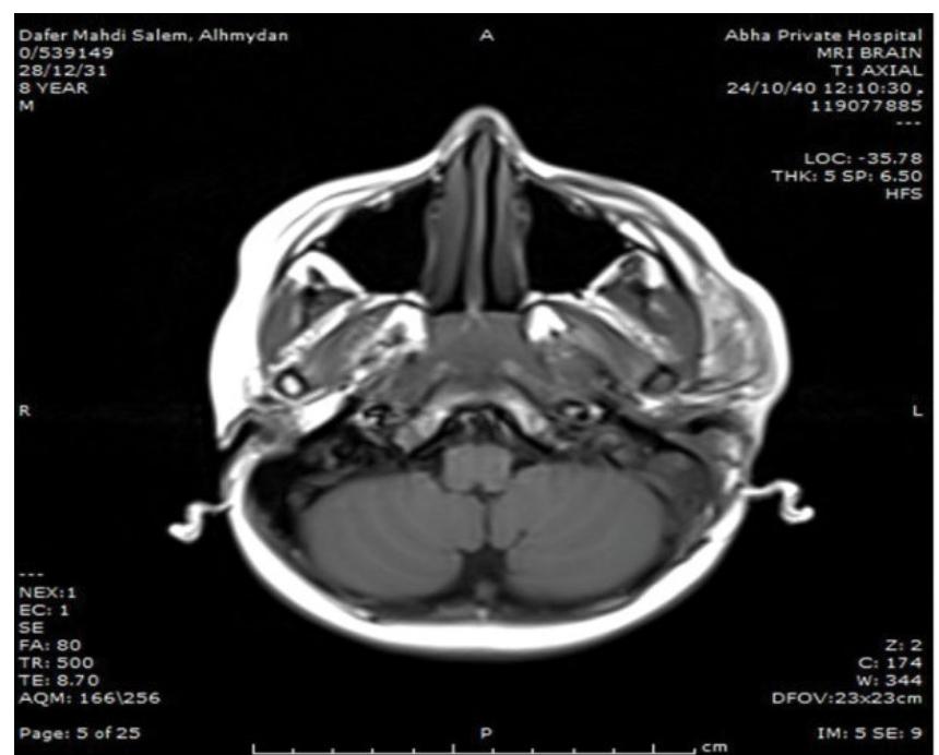 Mri showing the left mastoiditis and collection of fluid in