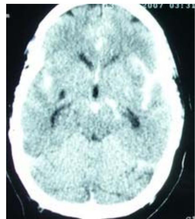 Ct scan showing presence of subarachnoid hemorrhage with