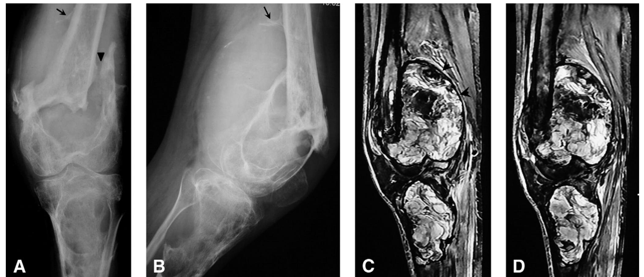 Anteroposterior (a) and lateral radiographs (b) of the left