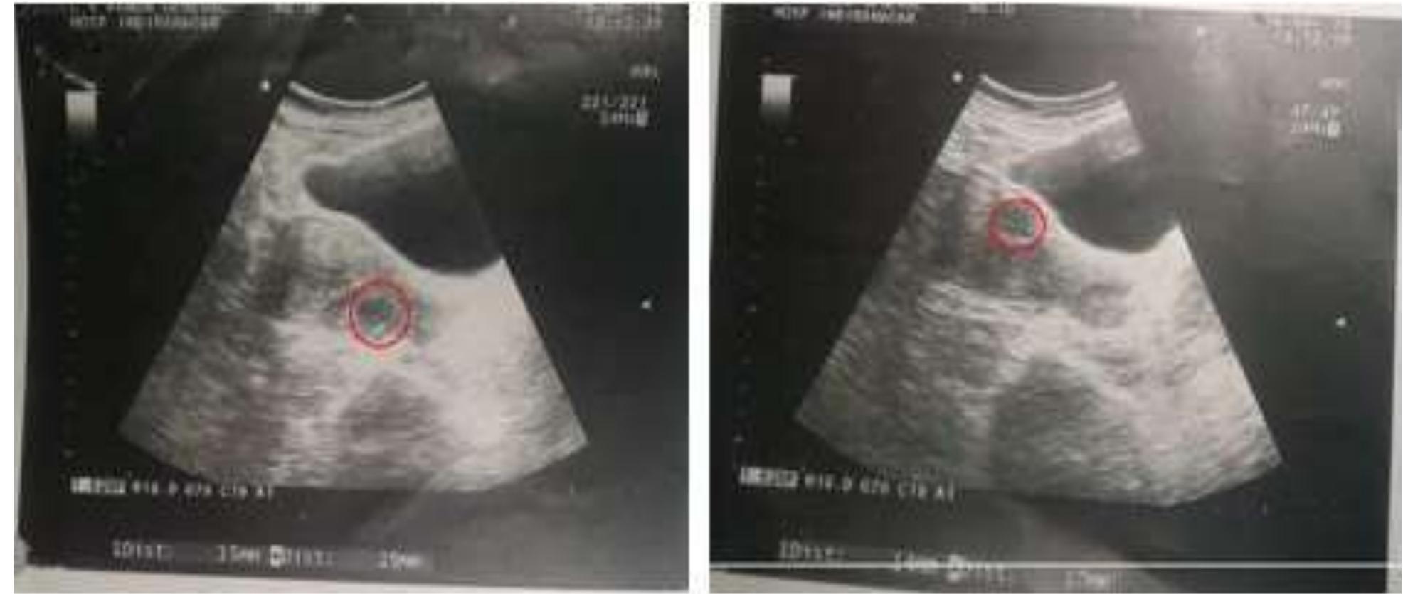 Ultrasonography of pelvis showing anterior and posterior