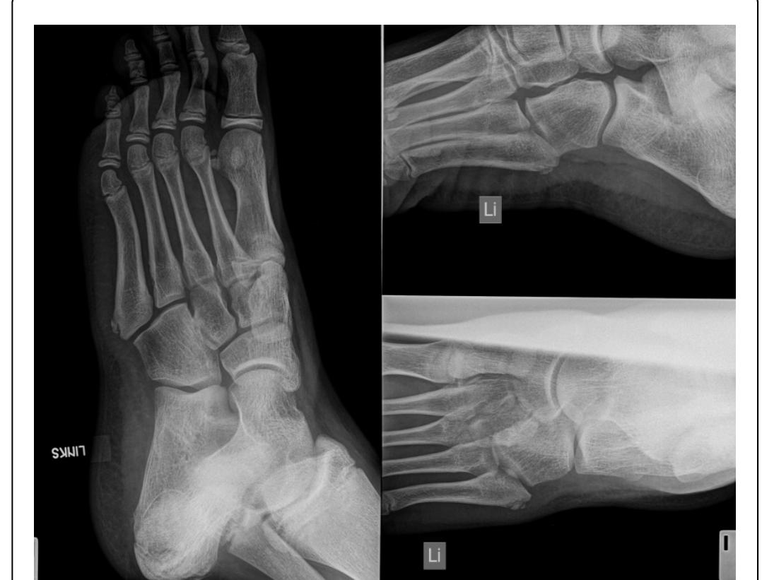 Lateral oblique radiograph of the left foot of the patient