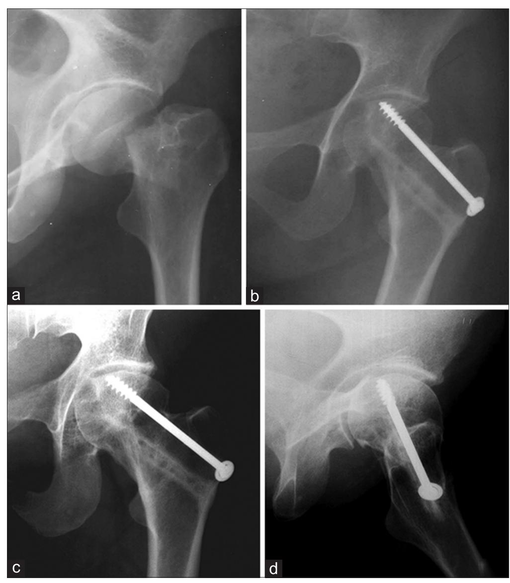(PDF) Nonvascularized fibular grafting in nonunion of femoral neck ...