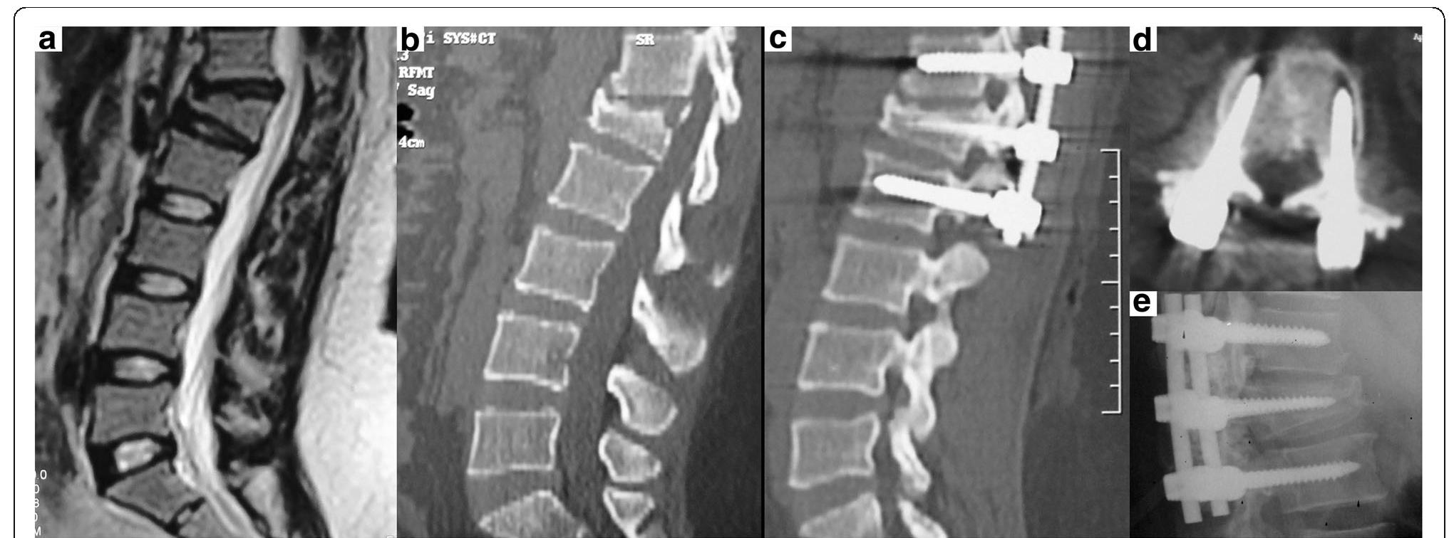 A pre-operative mri sagittal view of the l1 fracture. b
