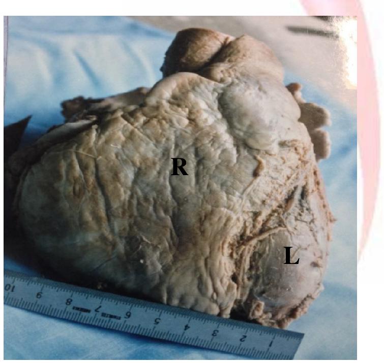 Photograph of the heart that contained the atrial septal