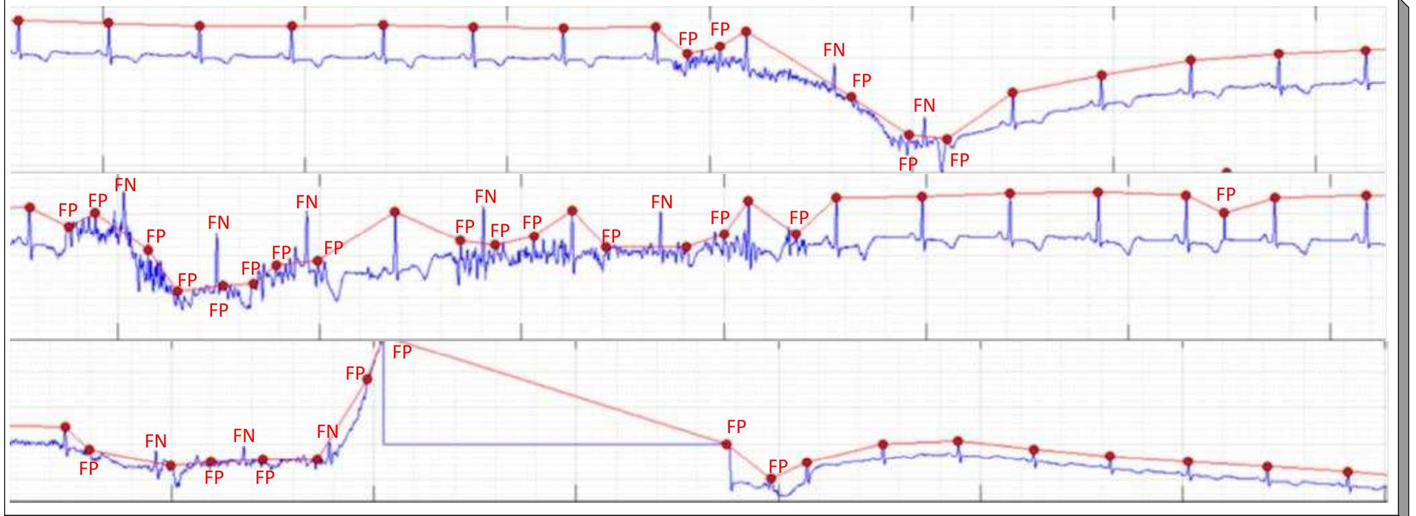 Typical holter ecg segments from the record of patient 6 in
