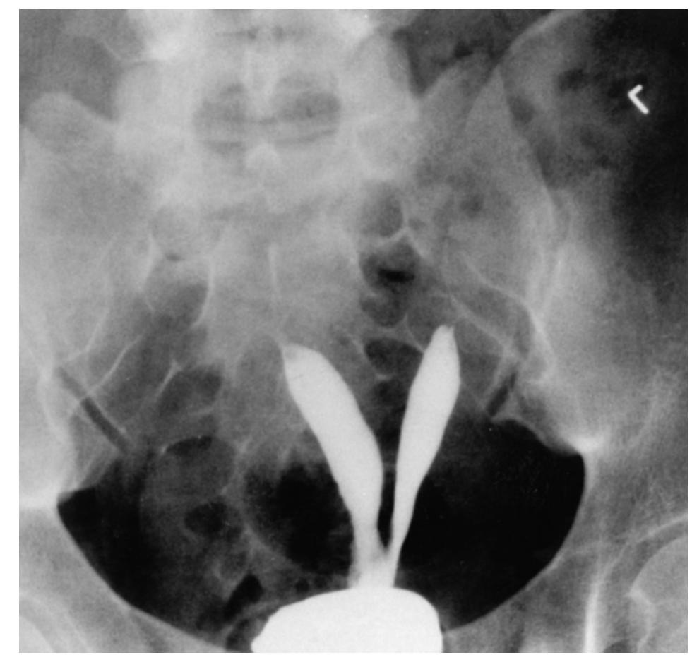 Hysterosalpingogram of a midline uterine septum that deeply