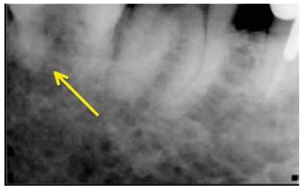 Ankylosed third molar roots figure 2. intraoral aspect of