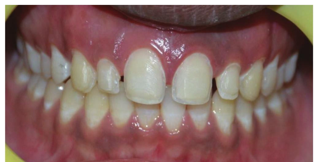 Figure 3 - Management of Spacing in Maxillary Anterior Teeth