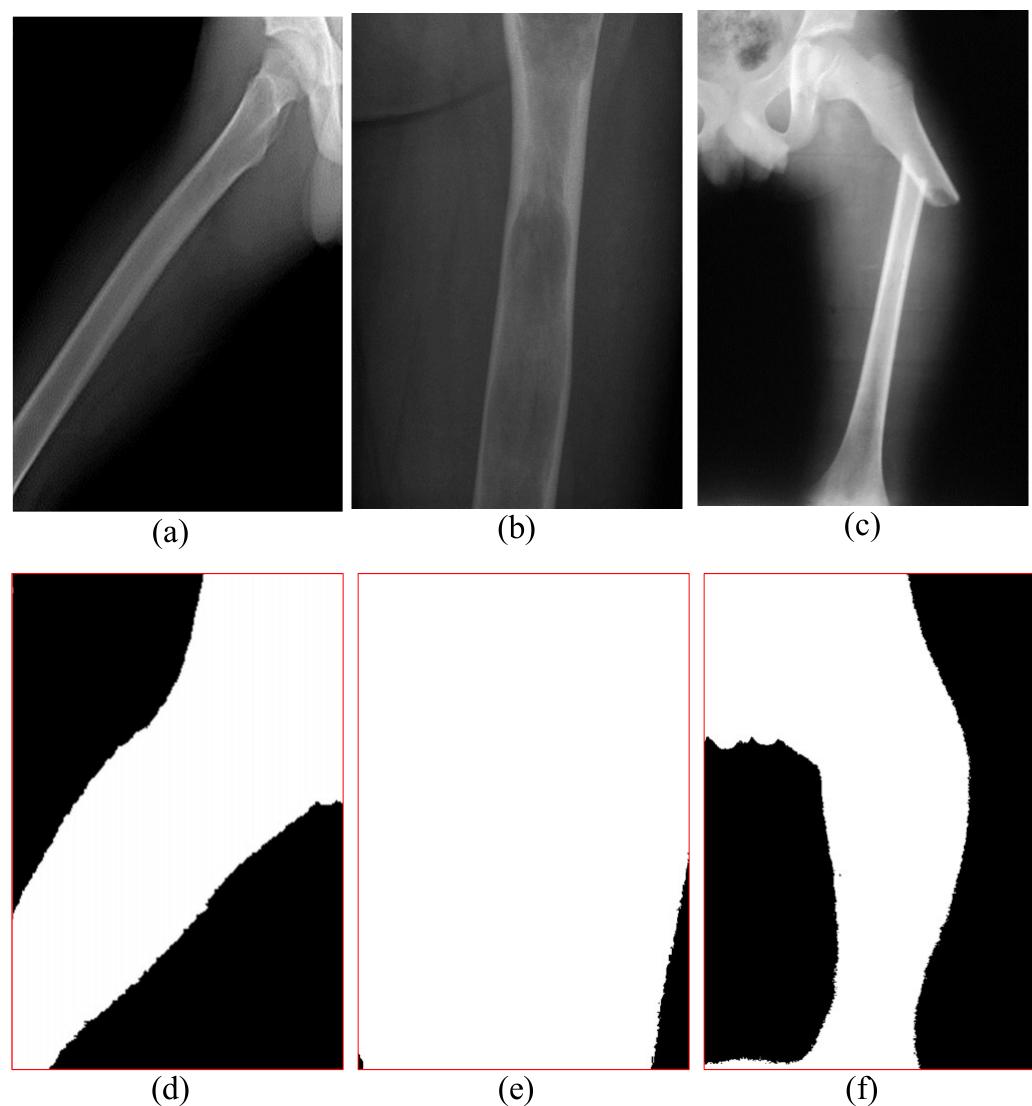 6. (a)-(c) original bone x-ray images, (d)-(e) correspoding