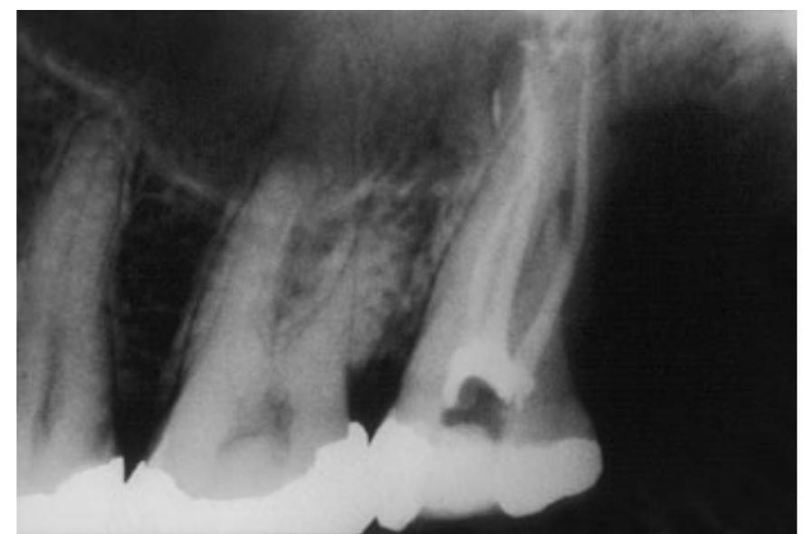 Postoperative radiograph of tooth 27.