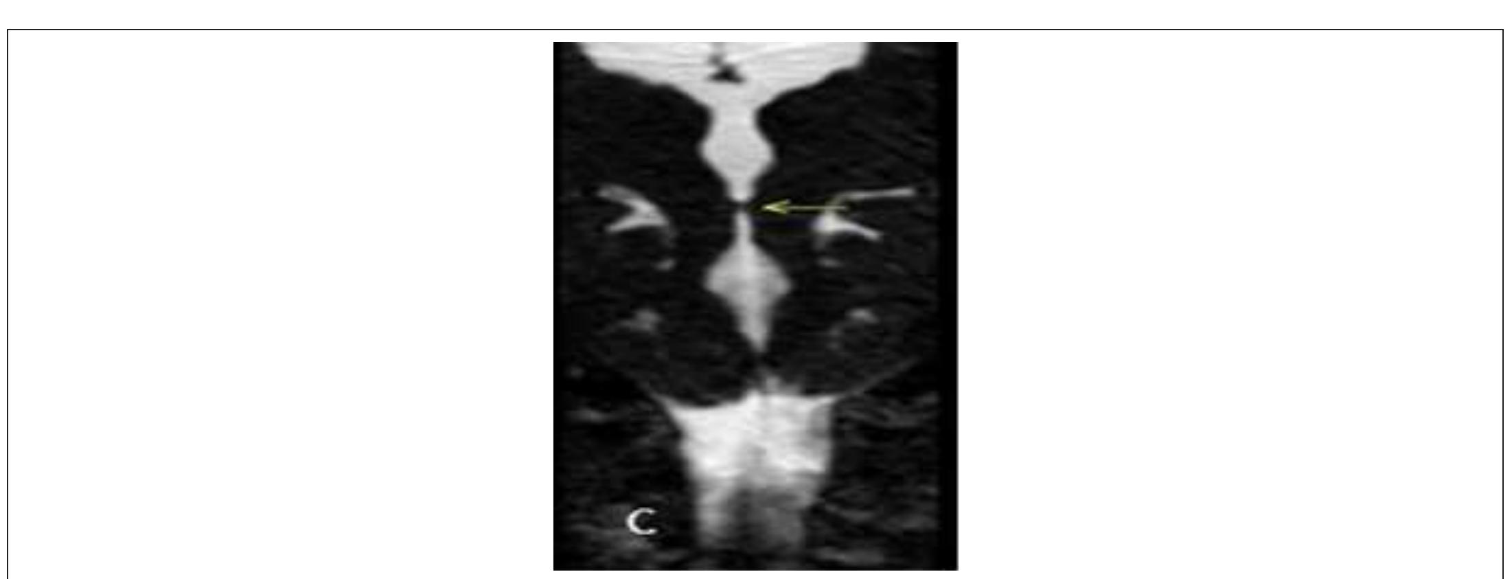C: coronal reconstruction from axial ciss 3d mri sequence.