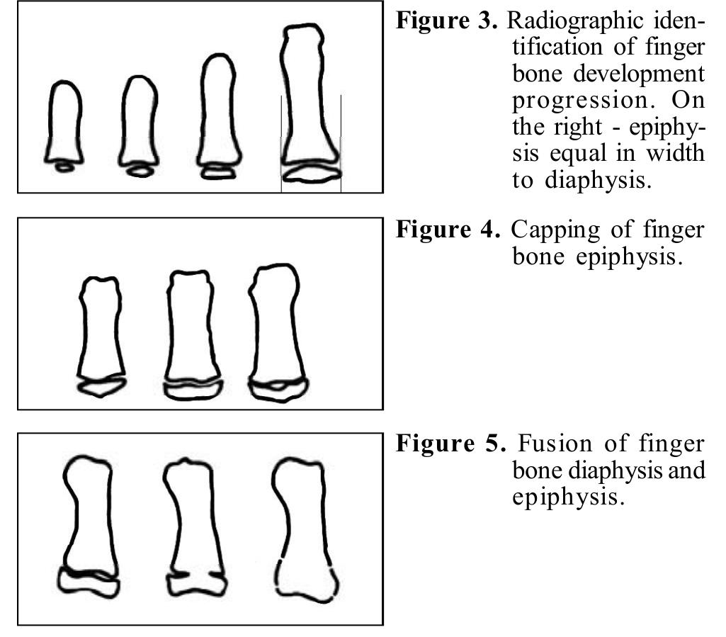 Schematic Diagram Of Endochondral Ossification A — Original