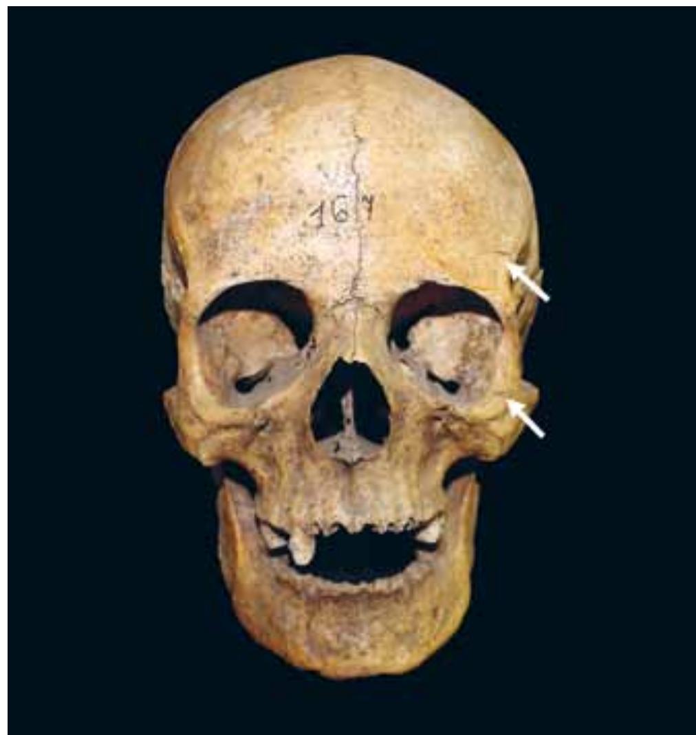 Perimortem trauma on the left side of the frontal bone and