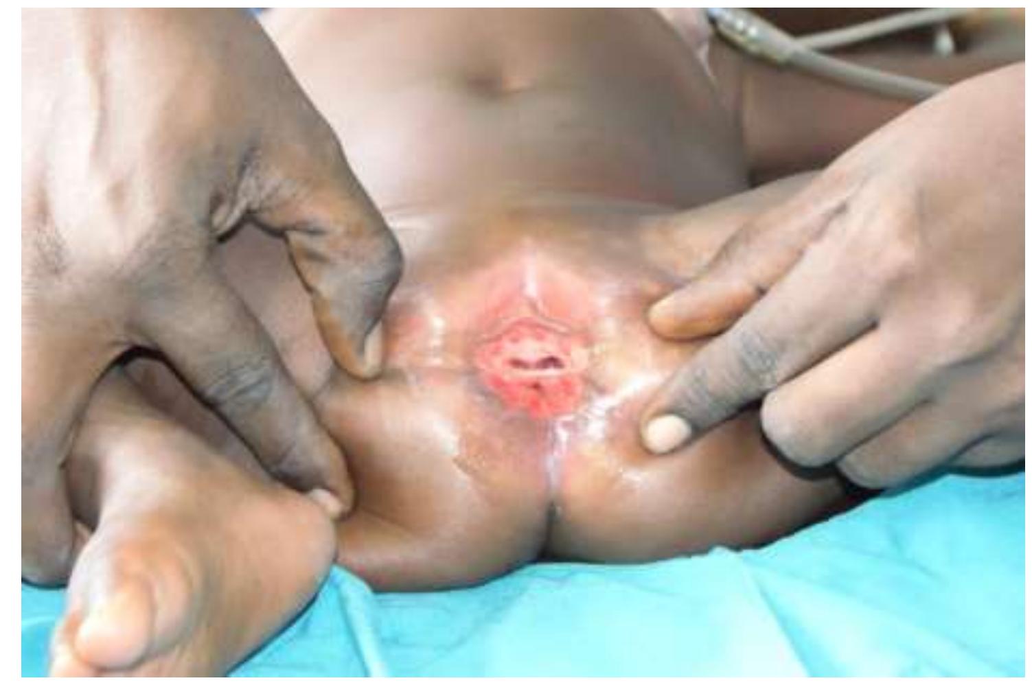 Perineo-genital injuries at presentation.
