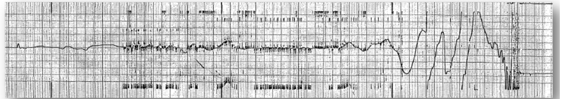 B-1. example of original strip chart recording