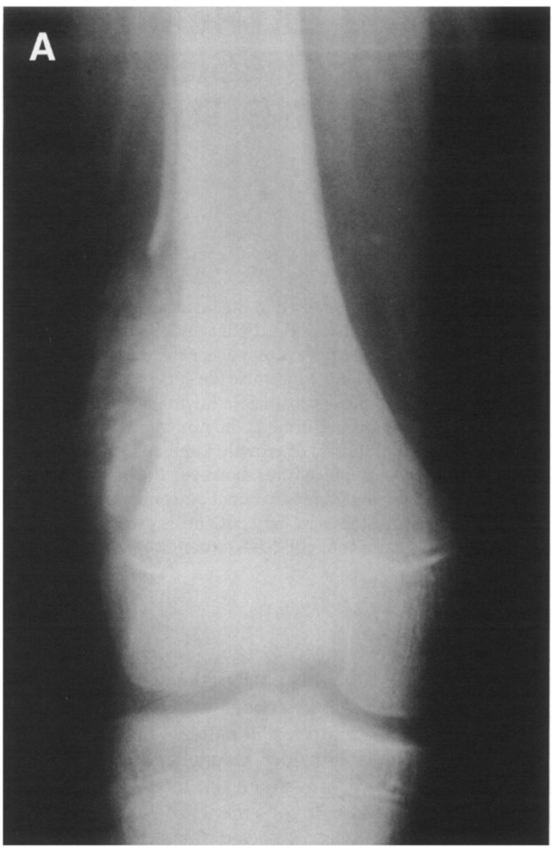 (a-d) a 10-year-old girl with osteosarcoma of the distal