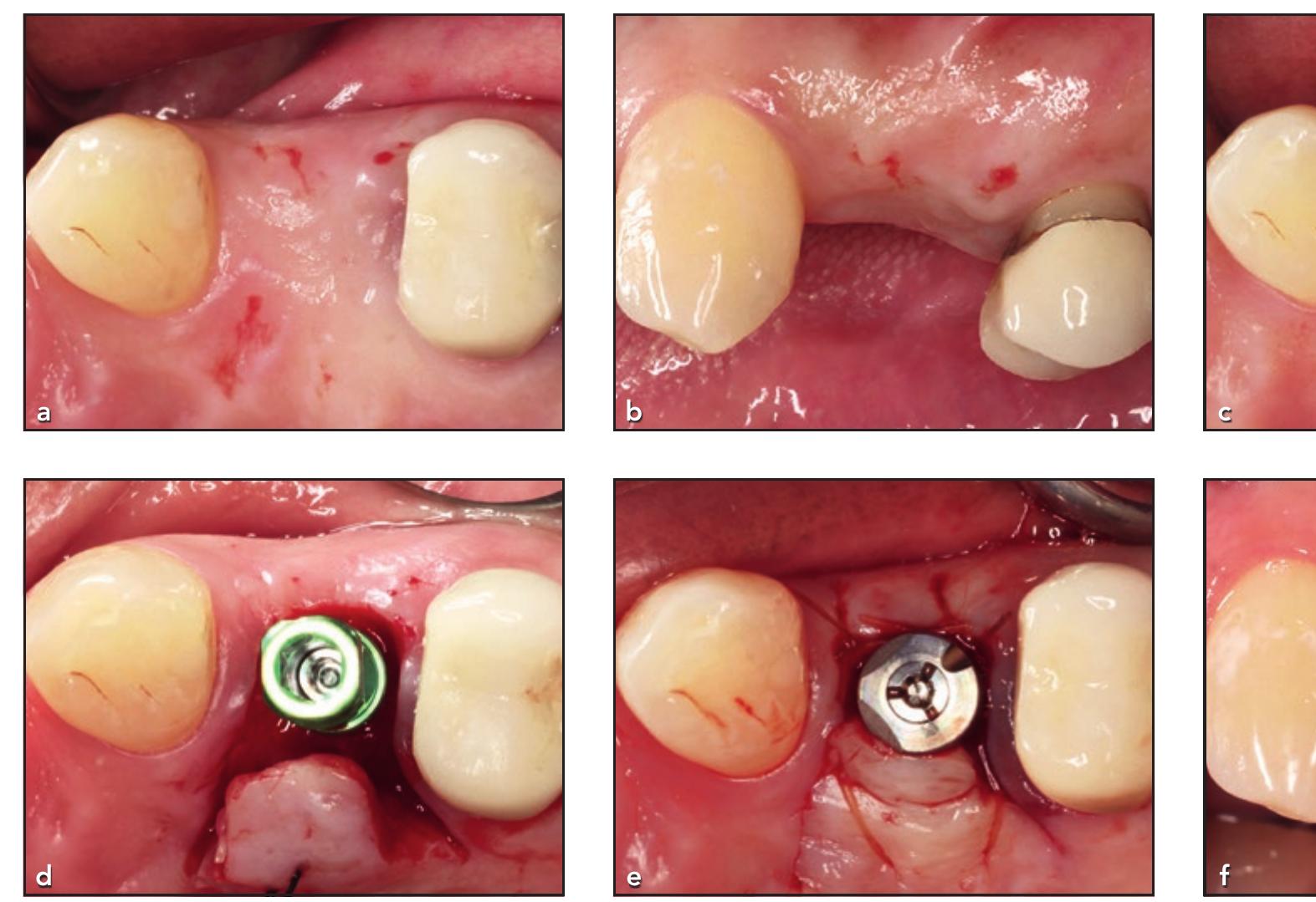 The surgical protocol for the paf technique. (a) occlusal