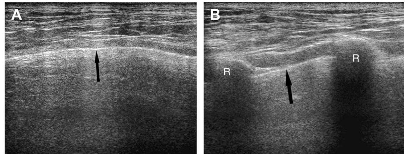 (a) transverse ultrasound scan of a normal thorax. the