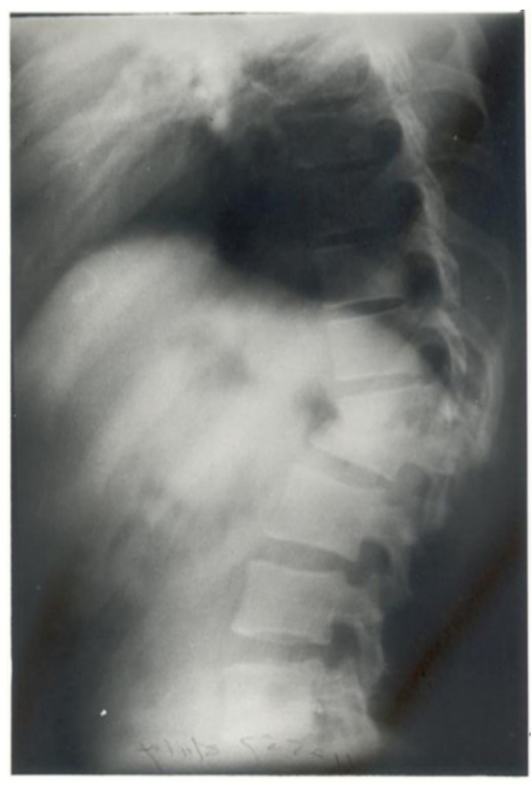 A: x-ray of the thoracolumbar spine (lateral view) showing