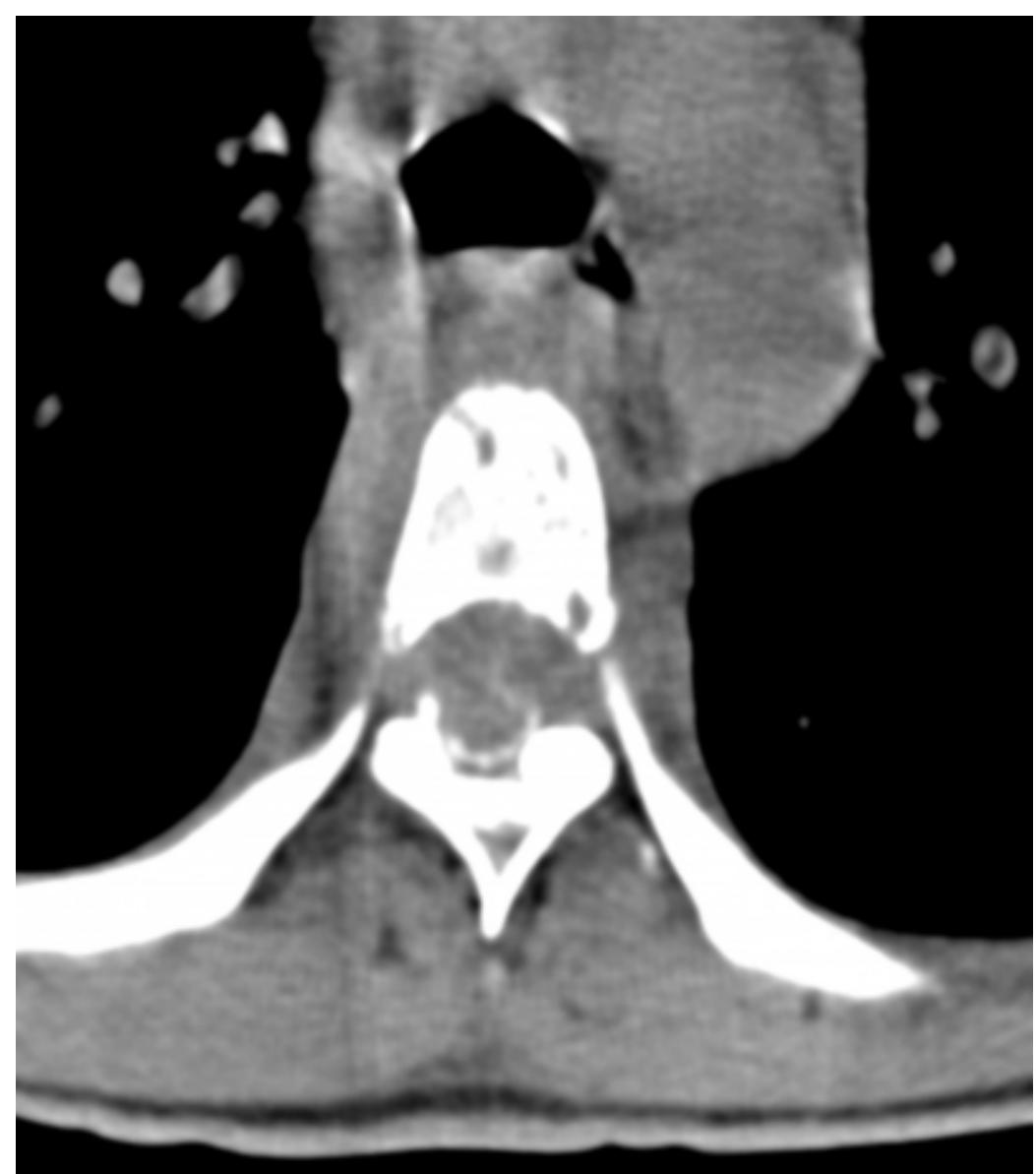 B: ct scan showing intraspinal extension with marked