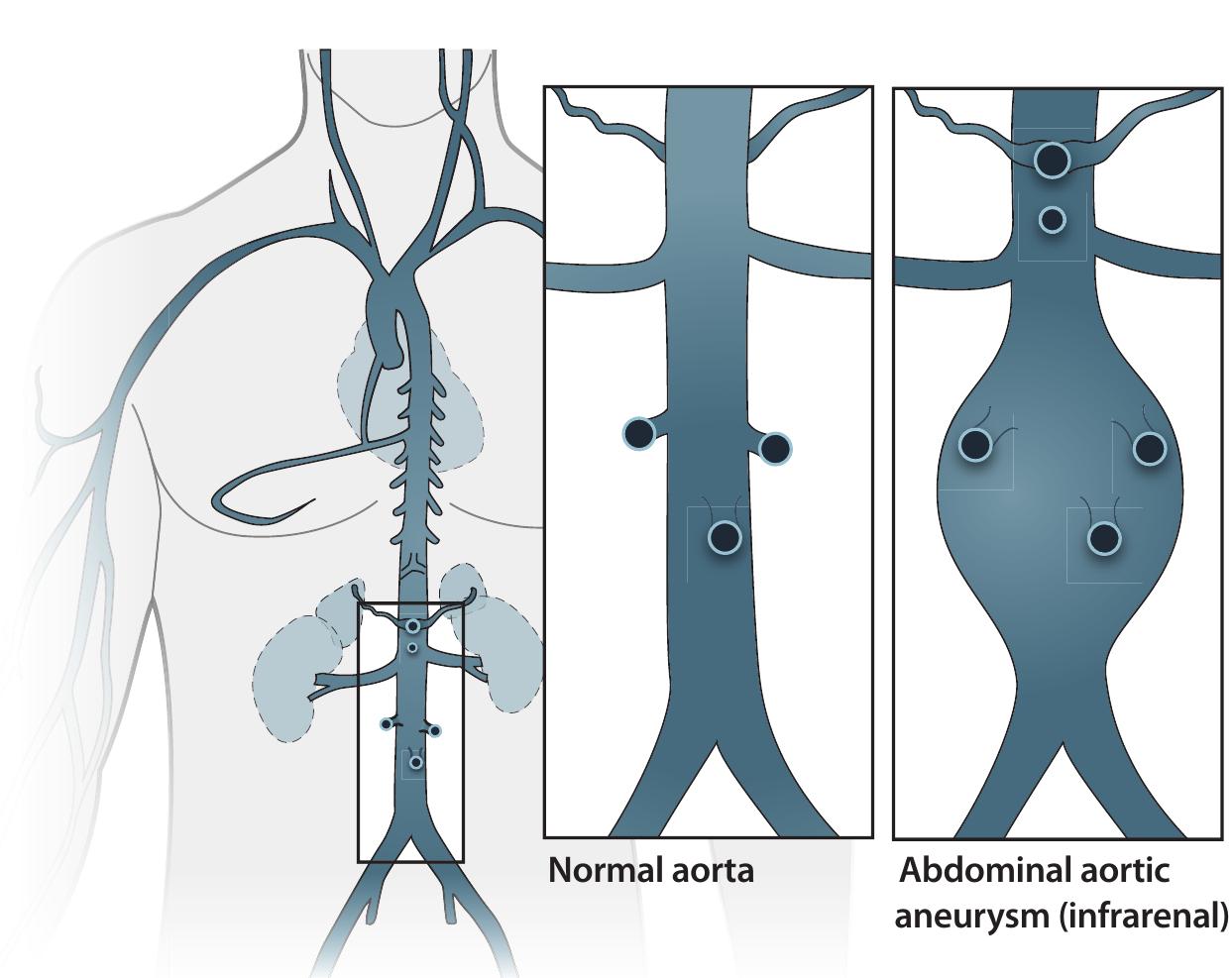 Diagram of an abdominal aortic aneurysm (aaa) as compared to