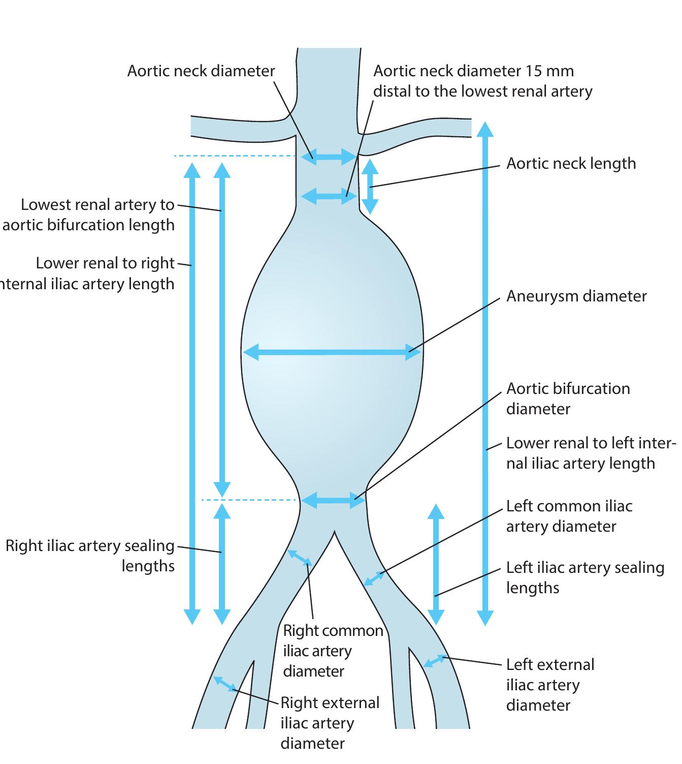 Schematic of various measurements of aorta and aneurysm for